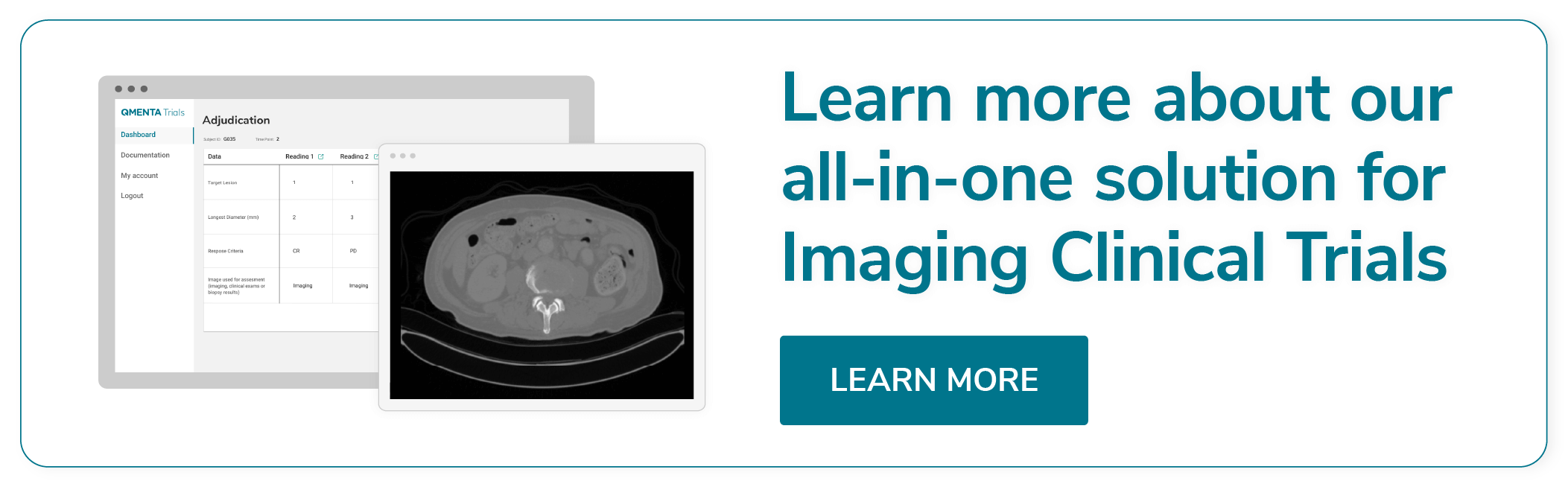 Covid 19 Kaggle Chest X Ray Normal Qmenta